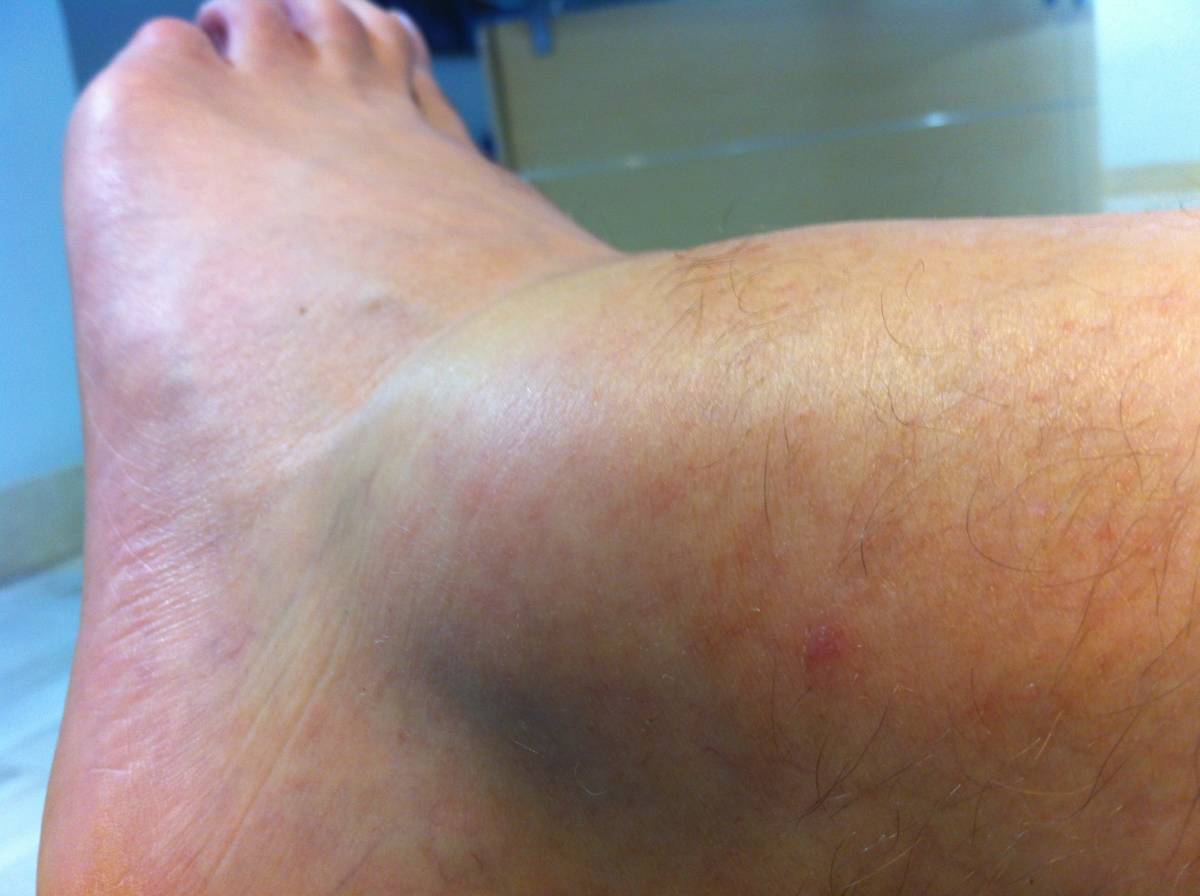 El esguince: Qué es, tipos, causas y tratamiento | Lesiones