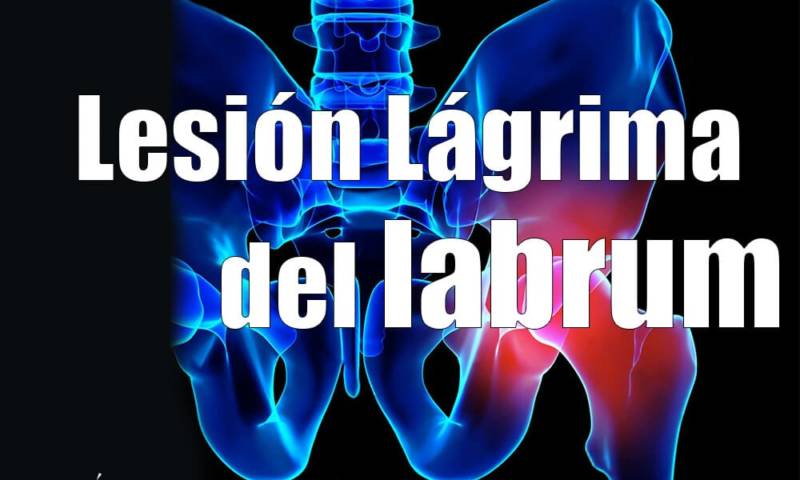 Lágrima del labrum | Lesión de cadera | Síntomas y tratamiento